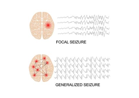 Generalized Seizure Eeg