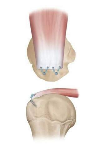 Surgical Management Of Rotator Cuff Pathology Flashcards Quizlet