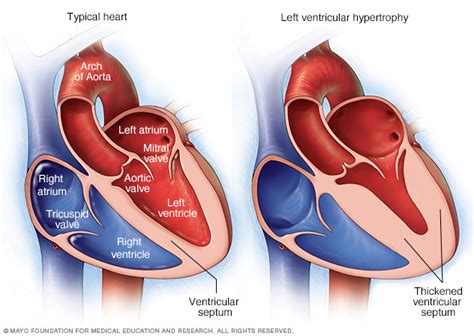Left Ventricular Hypertrophy Disease Reference Guide
