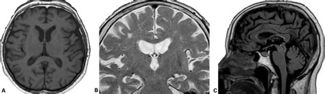 A Brain Section In Transverse Plane That Shows The Interventricular