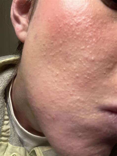 Any Idea How To Get Rid Of These Tiny Pimples Or What Theyre Caused By I Started 25mg Spiro