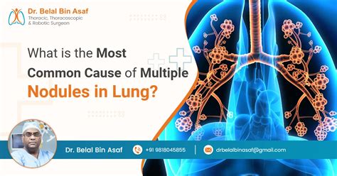 What Is The Most Common Cause Of Multiple Nodules In Lung