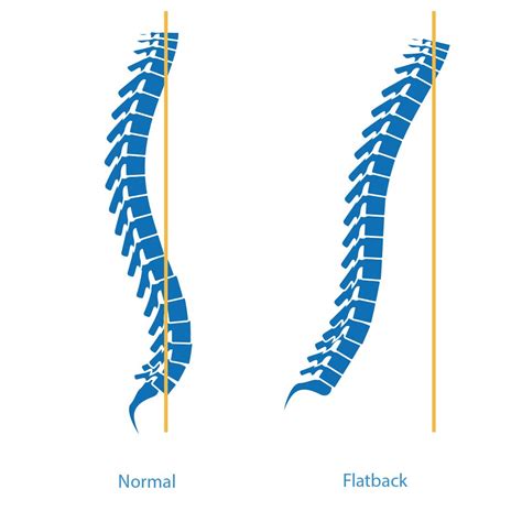 Adult Spinal Deformity Conditions Impact Overall Health National