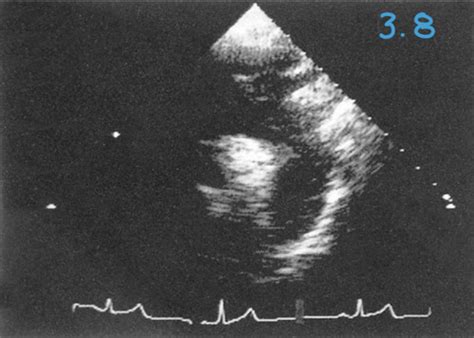 Aortic Arch From The Suprasternal Notch Flashcards Quizlet
