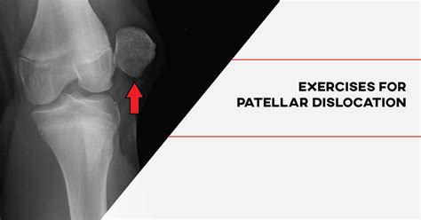 Exercises For Patellar Dislocation P Rehab Exercises For Patellar Dislocation P Rehab