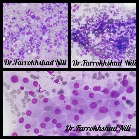 Farrokhshad Nili On Linkedin Thyroid Nodule Aspiration 35 Y O Female Isoechoic Indistinct Solid…
