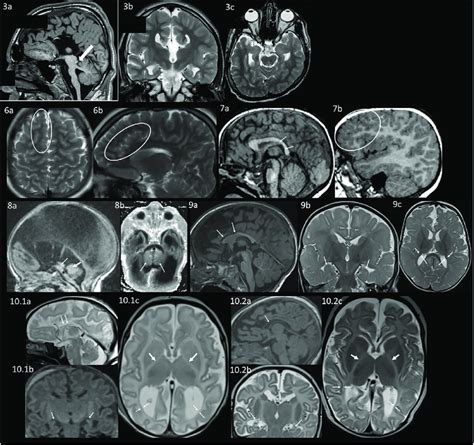 Neuroanatomical Differences Appreciated On Brain Mri Mri Of Individual Download Scientific