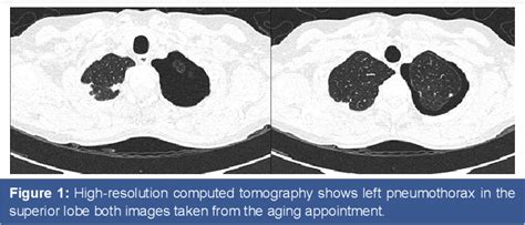 Figure 1 From Latrogenic Pneumothorax Caused By Thoracic Puncture