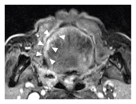 Clinical Findings Of The Patient A A Mass Lesion Of The Tongue An