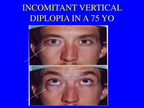 Ppt Incomitant Vertical Diplopia In A 75 Yo Powerpoint Presentation Free Download Id 3225788