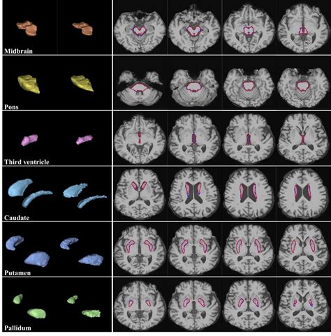 Segmentation Results Of Vit Based Unetr Left 3d Images In First Column Download Scientific