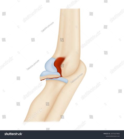 Causes Symptoms Capitellum Fracture Stock Vector Royalty Free
