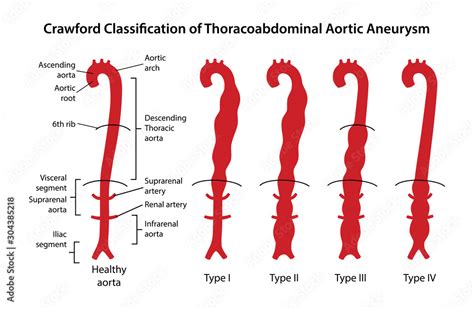 Vetor Do Stock Crawford Classification Of Thoracoabdominal Aortic