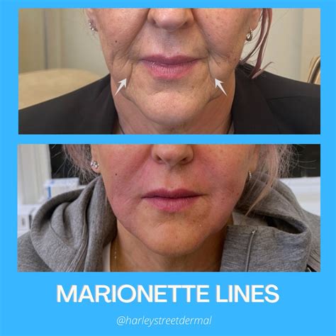 Marionette Lines Treating Marionette Lines Facial Acupuncture