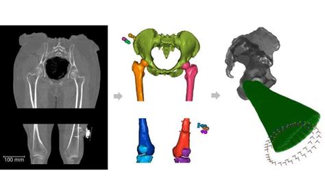 Force Sensor To Improve Hip Replacement Surgery • Healthcare In