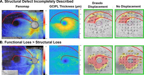 Data From Example Participants Where Ganglion Cell Analysis Gca