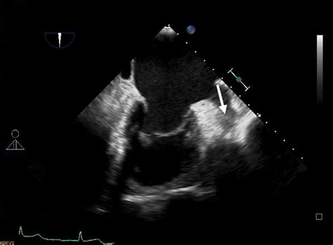 Laa Thrombus Arrow In 2d Transesophageal Echocardiography Tee Download Scientific Diagram