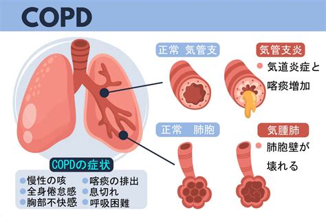 肺炎とcopdの違いは何ですか？ Copd 治療 ガイドライン Dobr