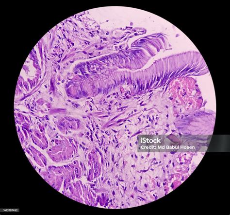 Microscopic Image Of Stomach Body Hyperplastic Polyp Show Gastric