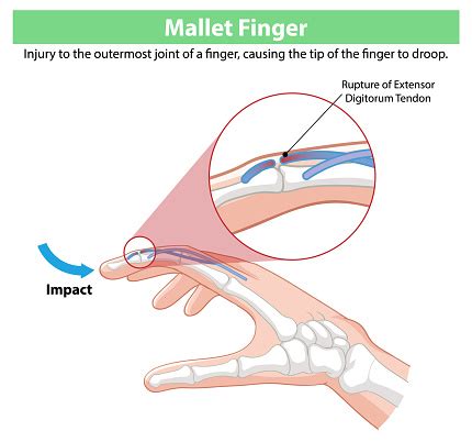 Diagram Showing Mallet Finger Injury And Tendon Rupture Stock
