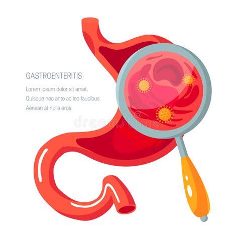 Gastroenteritis Concept In Flat Style Vector Icon Stock Vector
