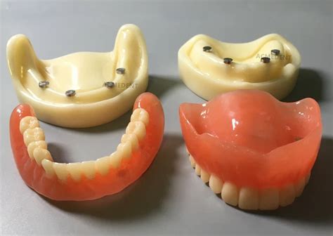 Dental Full Denture Model Overdenture Magnetic Attachment Mandibular