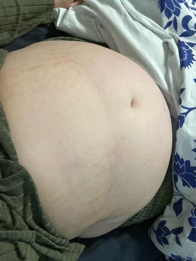 My New Stretch Marks 😍 Tumbex