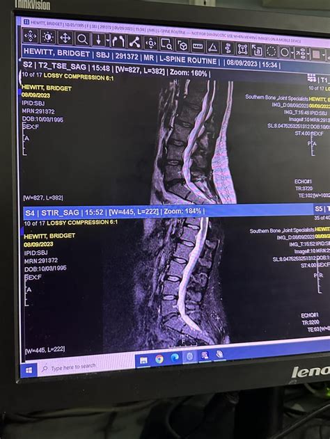 Mri Results Large Herniated L5 S1 Rsciatica
