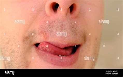 Man With Herpes On Lips Against Light Grey Background Cold Sore On A
