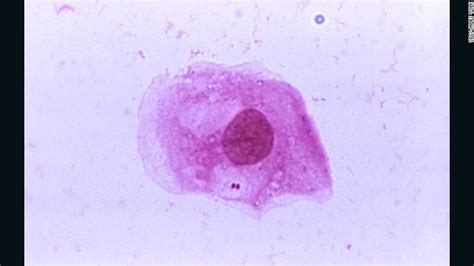 Is The End In Sight For Meningitis Cnn