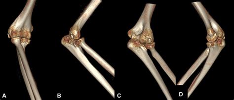 A And B Ct Image Of Bone Component Or Heterotopic Ossification Near Download Scientific