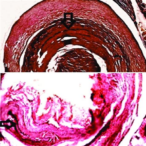 Ab Avm Elastic Stain Highlights The Disruption Of Elastic Lamina Ab Avm Elastic Stain Highlights The Disruption Of Elastic Lamina