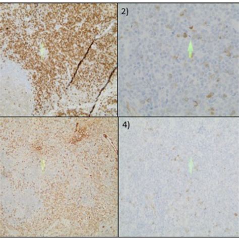 Lymph Node Biopsy Histopathological Diagnostic Criteria For Igg4 Rd Download Scientific