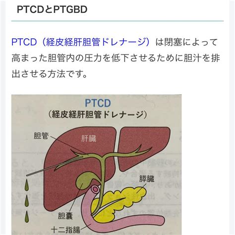 Kkdreamer 胆道ドレナージ（ptcdptgbdenbderbd）の違いと管理方法についてブログ更新し