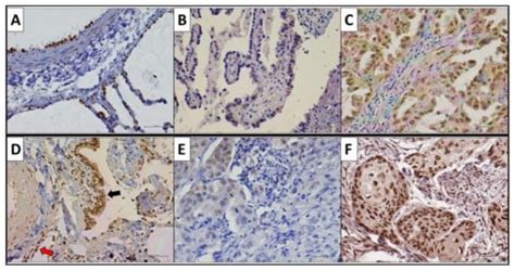 Patz1 In Non Small Cell Lung Cancer A New Biomarker That Negatively