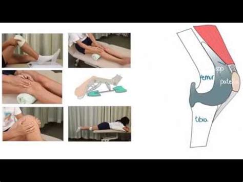 What Is Arthrofibrosis YouTube