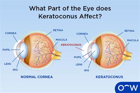 Keratoconus Diagram Keratoconus A Vision Disorder Steadfast