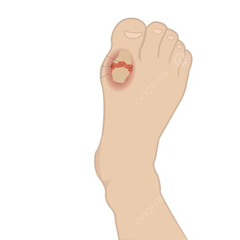 Gout Foot Vector Design Images Gout Arthritis Human Foot Vector