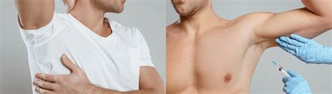 Hyperhidrosis Dermco