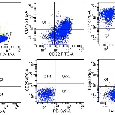 Immunophenotyping Findings In Case 1 Showed Expression Of Cd19 Cd20 Download Scientific