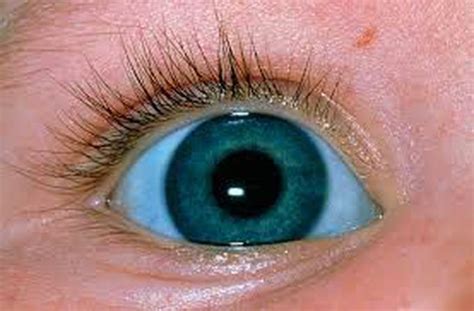 Blue Sclera Medizzy