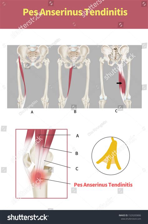 Medical Illustration Explain Pes Anserinus Tendinitis Stock