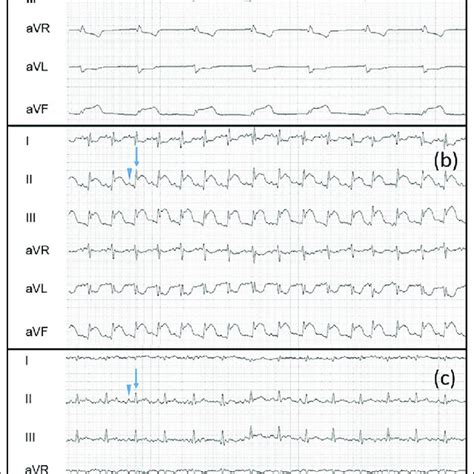 A Initial Six Lead Electrocardiography Tracing From Case 1 Notice