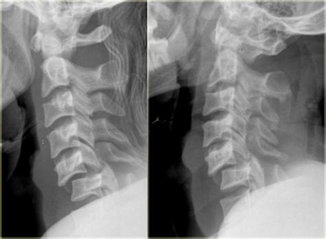 Dislocated Neck X Ray