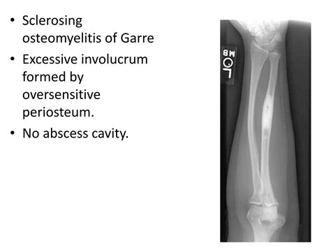 Osteomyelitis Pptx