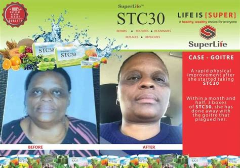 Goitre Illness And Its Permanent Cure Health Nigeria