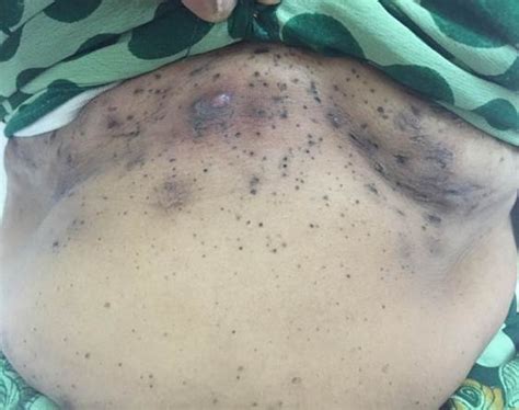 Hyperpigmented Macules In Inframammary Region Download Scientific Diagram