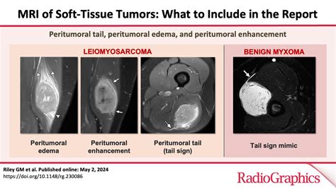 Mri Of Soft Tissue Tumors What To Include In The Report Radiographics