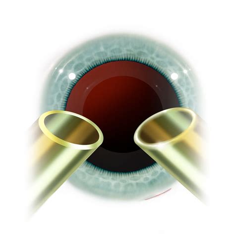 Dewey Radius Phaco Tips 09mm Straight Dewey Phaco Tip 30 Degree Bevel Microsurgical Technology