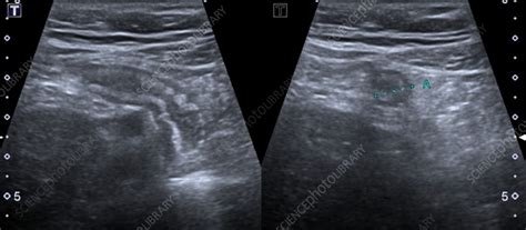 Appendicitis Ultrasound Scan Stock Image F042 7335 Science Photo Library